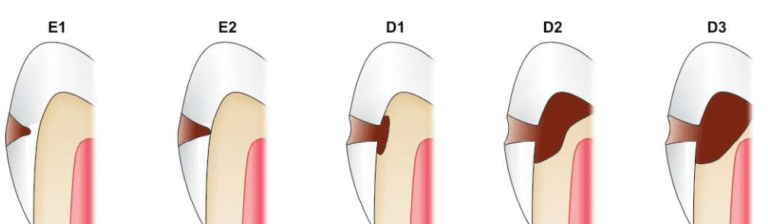 Classification of Dental Caries