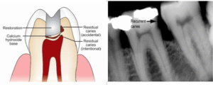Classification of Dental Caries