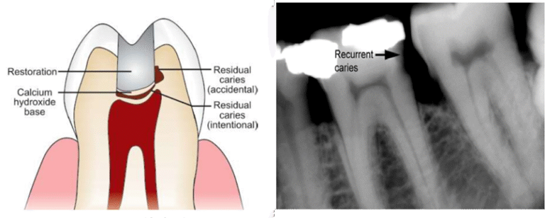 Classification of Dental Caries