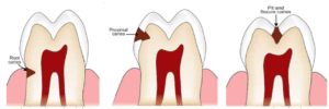 Classification of Dental Caries