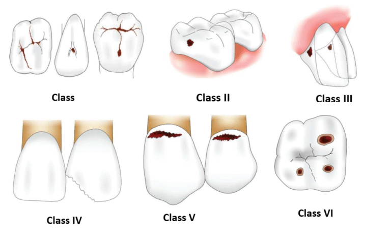 Classification of Dental Caries