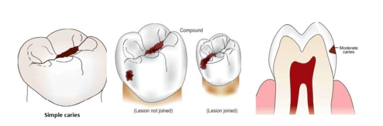 Classification of Dental Caries
