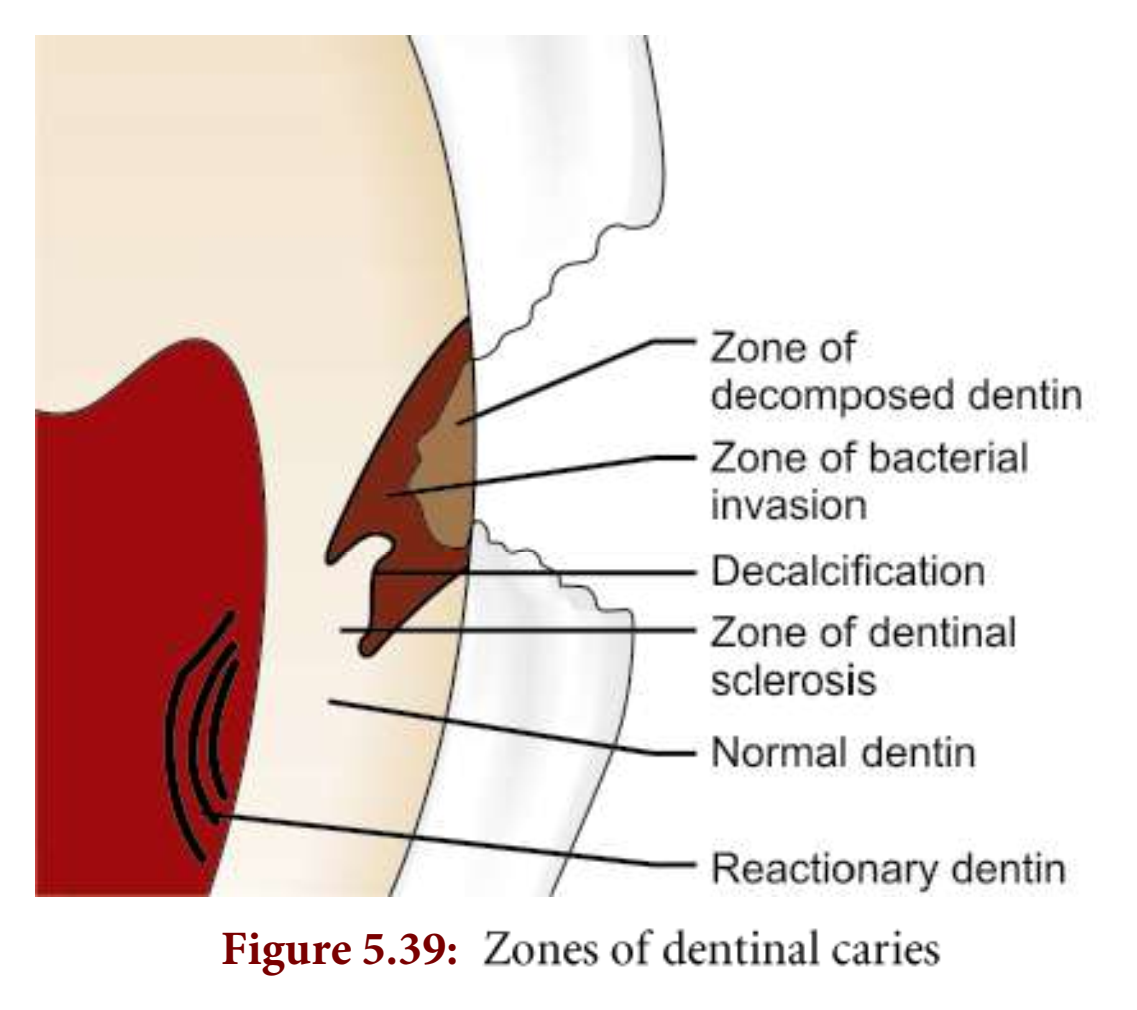 Histopathology of Dental Caries - Edudentists.com | Dental Questions ...
